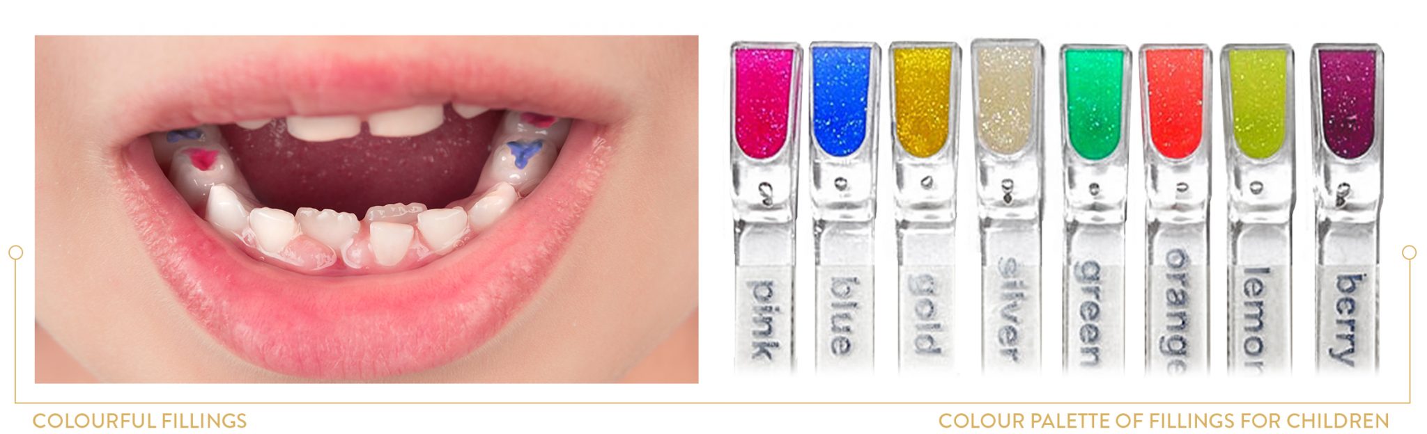 Coloured Tooth fillings – Mediatrix