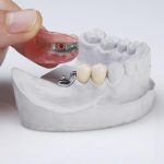 Precision attachments – Mediatrix