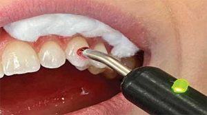 Pulp Testing – Mediatrix